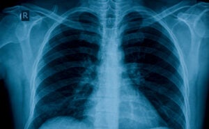 Chest X-Rays for COPD: Images, Diagnosis, and Staging