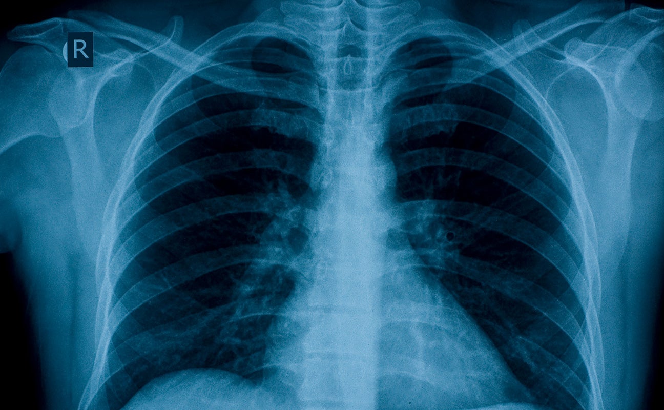 Chest X-Rays for COPD: Images, Diagnosis, and Staging