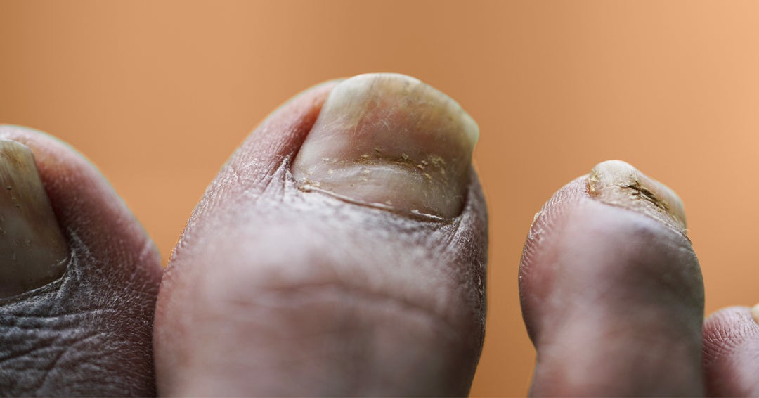 Psoriatic Arthritis in Your Toes: Pictures, Symptoms, and Treatment